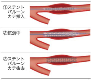 虚血性心疾患：経皮的冠動脈形成術（PCI） – 医療法人恵山会 丸山病院