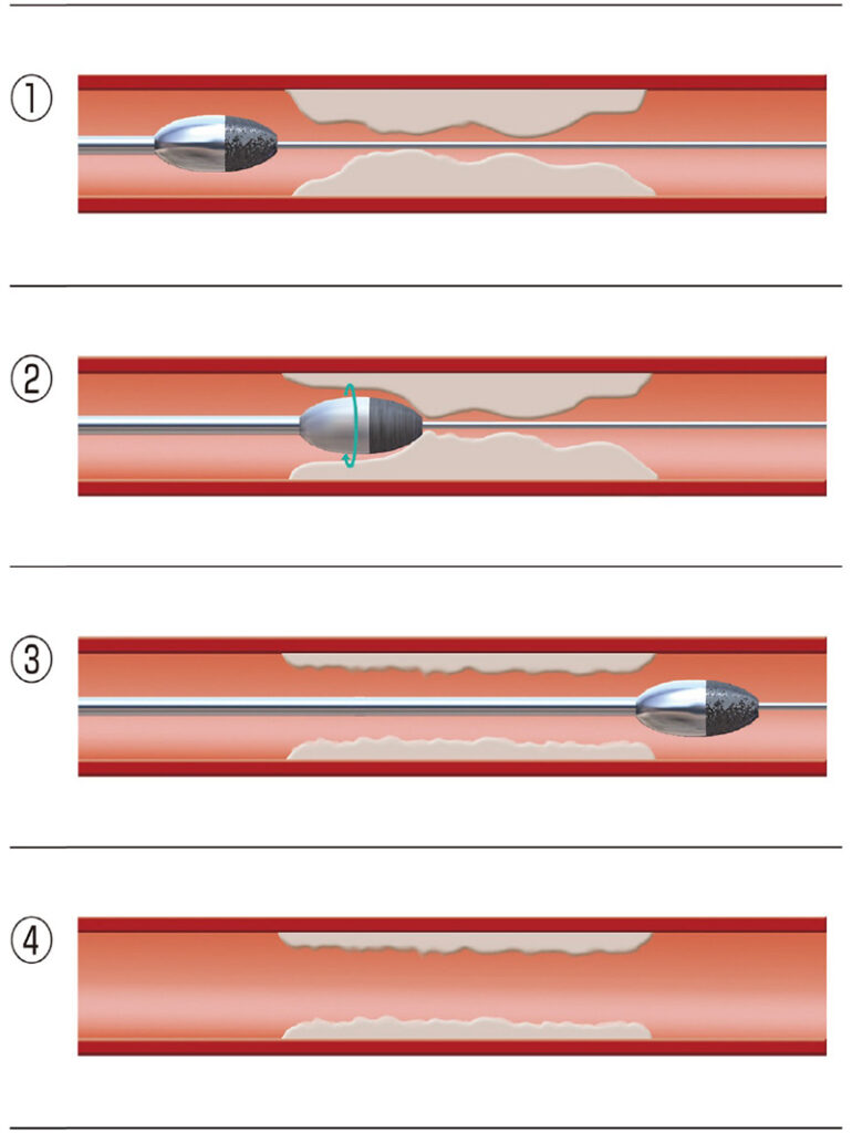 ＜サイドメモ＞PCIの特殊な治療器具 – 医療法人恵山会 丸山病院