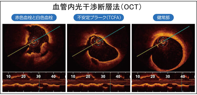 ＜サイドメモ＞PCIを支える画像診断 – 医療法人恵山会 丸山病院