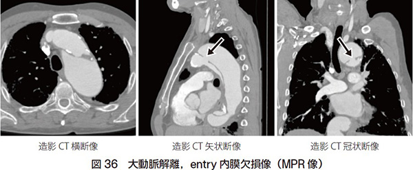 大動脈解離とは？ – 医療法人恵山会 丸山病院